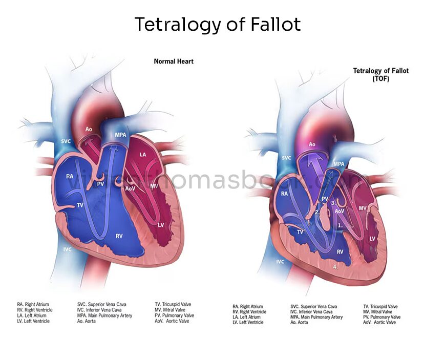 Vivien Thomas’s Break-out Blue Baby Surgery - Vivien Thomas Book